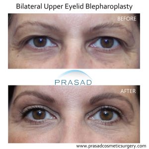 What Causes Heavy Lidded Eyes and How to Treat Them