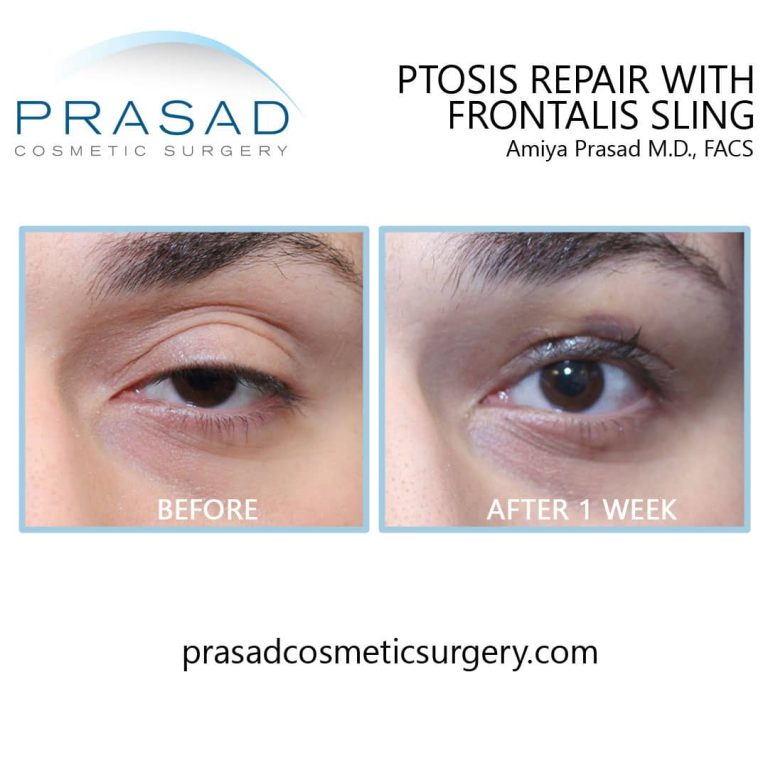 Healing After Ptosis Surgery Dr Prasad Blog