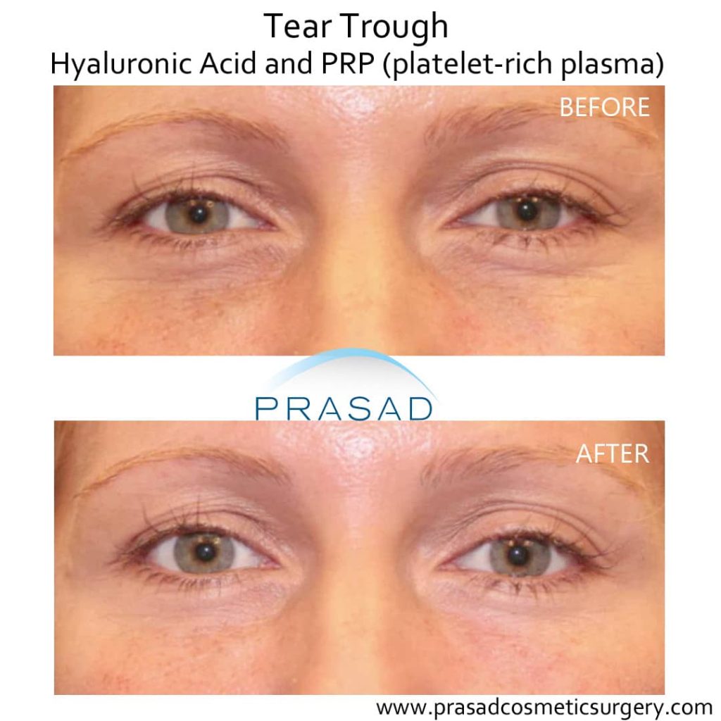 Under Eye Filler Before and After Photos - Prasad Cosmetic Surgery