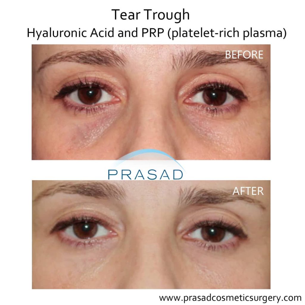 Under Eye Filler Before and After Photos - Prasad Cosmetic Surgery