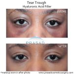 Benefits of PRP Injection Under Eyes - Dr. Prasad | New York