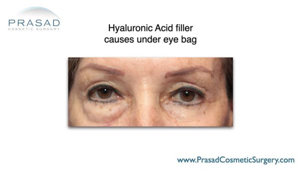 Under Eye Fillers Gone Wrong. What to Do? - Dr. Prasad Blog