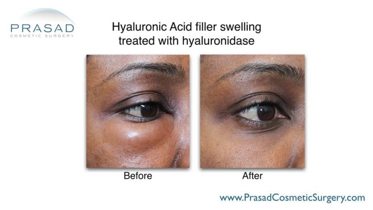 Under Eye Fillers Gone Wrong. What to Do? - Dr. Prasad Blog