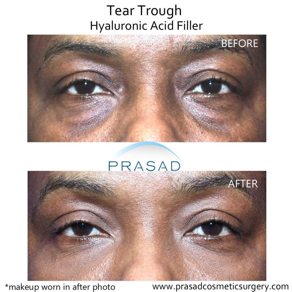 Under Eye Filler Before and After Photos - Prasad Cosmetic Surgery