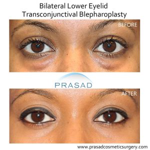 Eyelid Retraction: What It Is, Why It Happens, and How to Avoid It