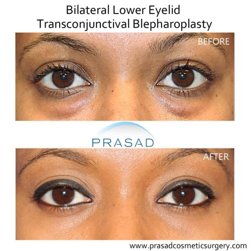 Eyelid Retraction: What It Is, Why It Happens, and How to Avoid It