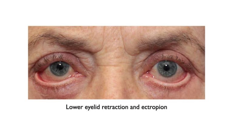 Eyelid Retraction: What It Is, Why It Happens, and How to Avoid It