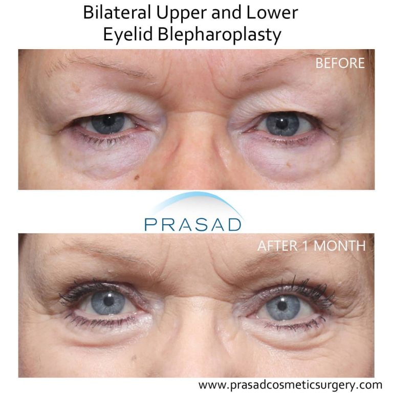 How Hooded Eye Surgery Scars are Minimized | Dr. Prasad Blog