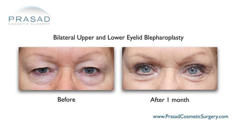 How Hooded Eye Surgery Scars are Minimized | Dr. Prasad Blog