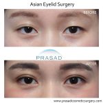 Asymmetrical Eyes - When Surgery is Recommended | Dr. Prasad