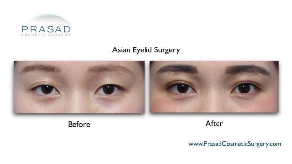 How is a Double Eyelid/ Eyelid Crease Created? | Dr. Prasad Blog
