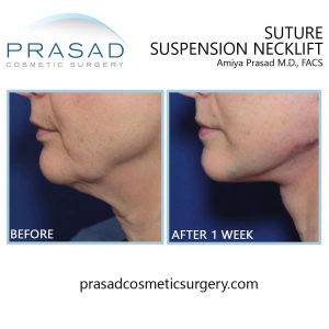 How to Tighten Neck Skin? Surgical and Non-Surgical Options