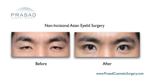 Parallel or Tapered Eyelid Crease for Asian Eye Surgery