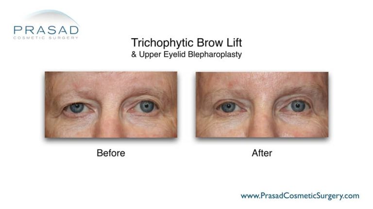 Brow Lift Before and After Photos | Manhattan and Long Island NY