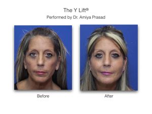 Y Lift® Non-Surgical Facelift - Dr. Amiya Prasad | New York