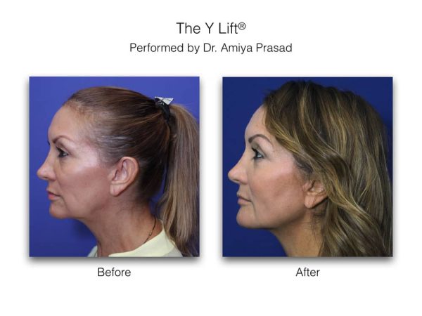 Y Lift® Non-Surgical Facelift - Dr. Amiya Prasad | New York