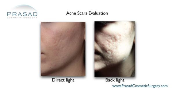Stubborn Acne Scar: What is the Best Treatment? | Dr. Prasad Blog