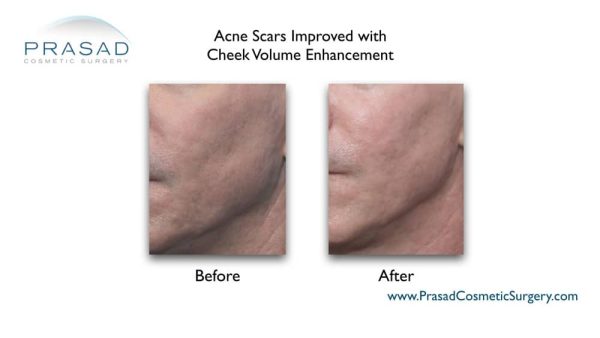 Stubborn Acne Scar: What is the Best Treatment? | Dr. Prasad Blog