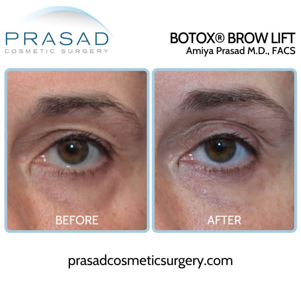 Brow Lift Before and After Photos | Manhattan and Long Island NY