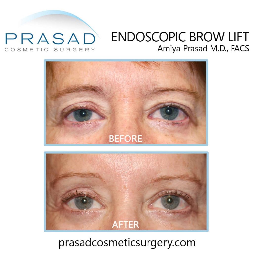 Brow Lift Before and After Photos | Manhattan and Long Island NY