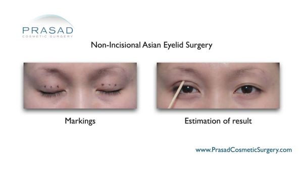 Should I Get Double Eyelid Surgery? - Prasad Cosmetic Surgery