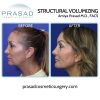 Y Lift® Non-Surgical Facelift - Dr. Amiya Prasad | New York