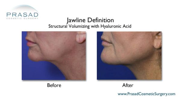 What is the Best Treatment for Sagging Jowls? | Dr. Prasad Blog