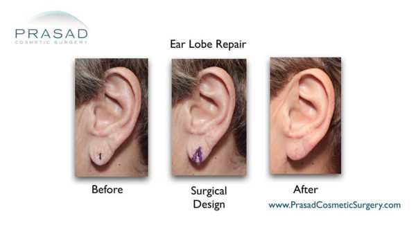 Can Stretched or Torn Earlobes be Repaired? - Dr. Prasad Blog