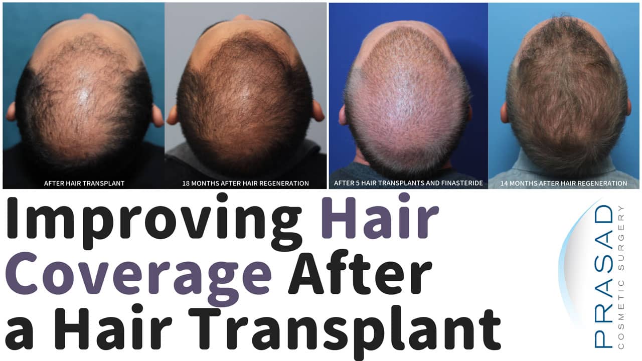 How Do You Fix a Failed Hair Transplant? | Dr. Prasad Blog