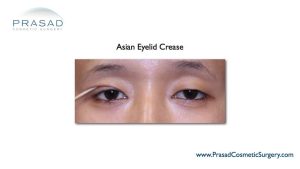 Parallel or Tapered Eyelid Crease for Asian Eye Surgery
