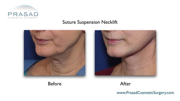 How to Choose the Best Neck Lift Procedure | Dr. Prasad Blog
