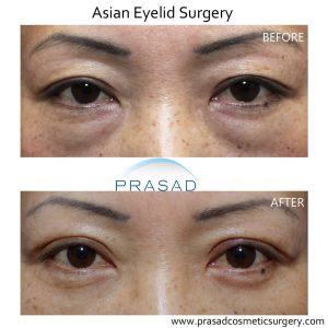 Parallel or Tapered Eyelid Crease for Asian Eye Surgery