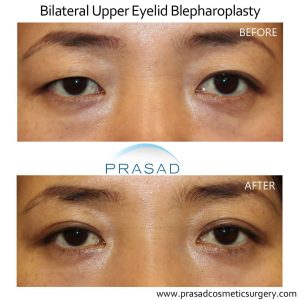 How Hooded Eye Surgery Scars are Minimized | Dr. Prasad Blog