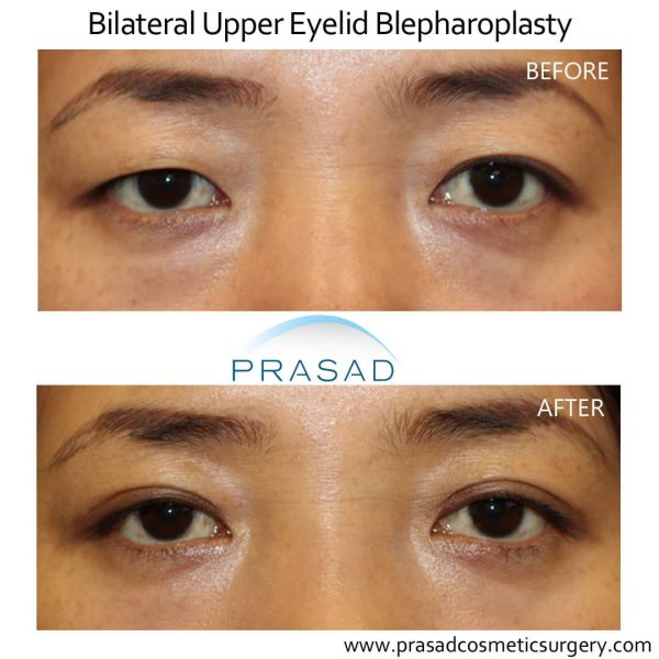 How Hooded Eye Surgery Scars are Minimized | Dr. Prasad Blog