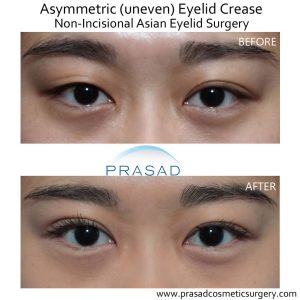 Uneven Eyes: When Treatment is Needed? | Dr. Prasad Blog