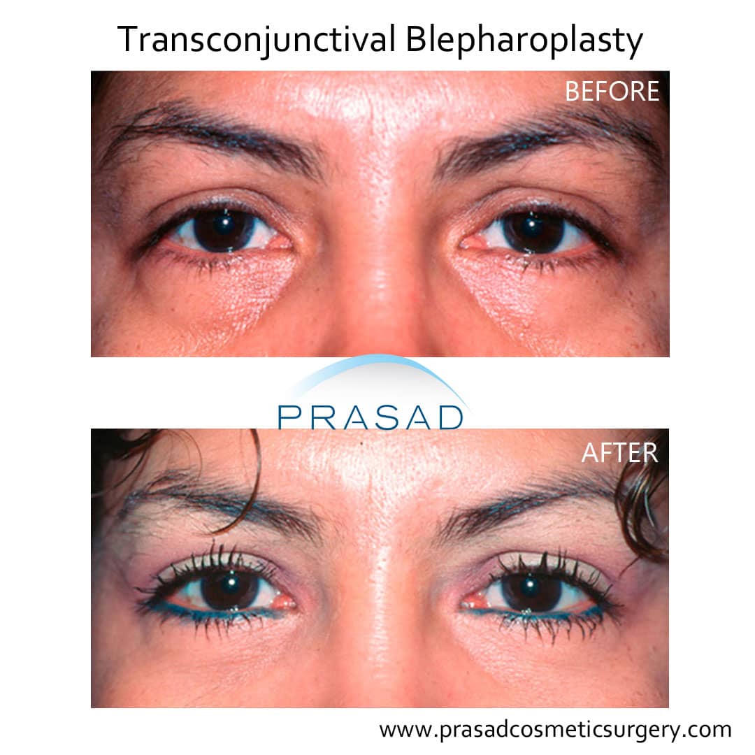 Blepharoplasty Before and After Photos | Prasad Cosmetic Surgery