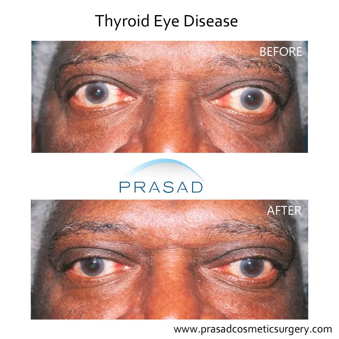 Thyroid Eye Disease Surgery/ Graves Eye Disease Surgery