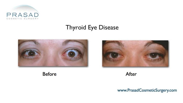 Thyroid Eye Disease Surgery/ Graves Eye Disease Surgery