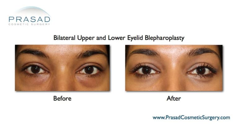 Blepharoplasty Before and After Photos | Prasad Cosmetic Surgery