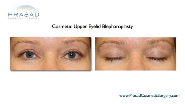 How Hooded Eye Surgery Scars are Minimized | Dr. Prasad Blog