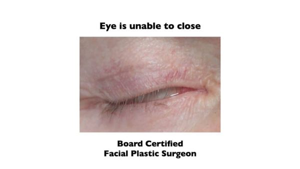 Can Upper Blepharoplasty Go Wrong? | Dr. Prasad Blog