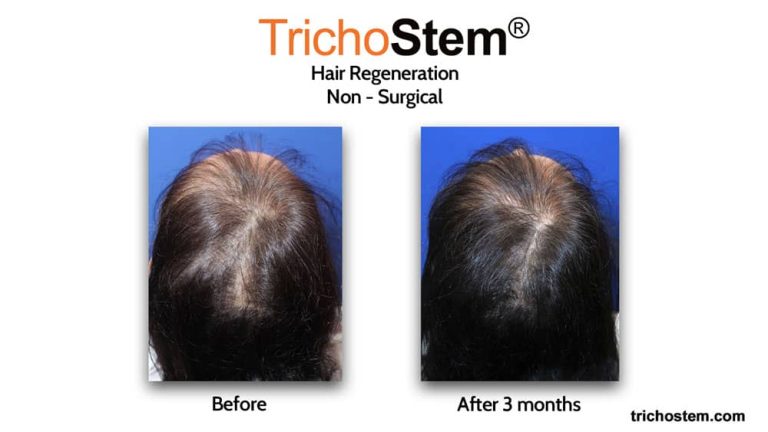 Differences Between Hair Shedding Vs Hair Loss Hair Fall