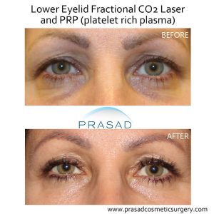 Benefits of PRP Injection Under Eyes - Dr. Prasad | New York