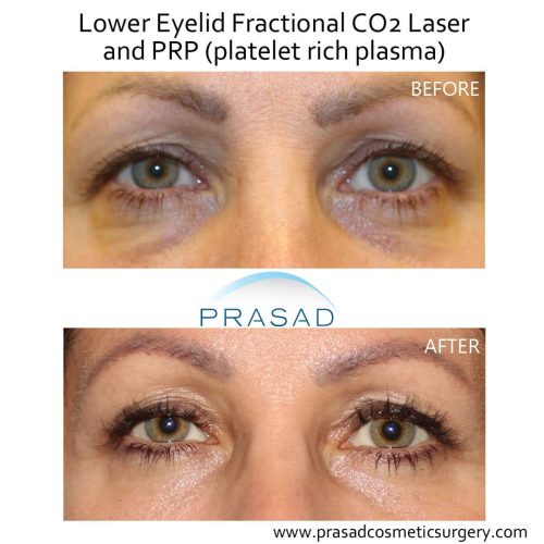 Benefits of PRP Injection Under Eyes - Dr. Prasad | New York