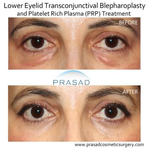 Why PRP or Lasers Don’t Work for Puffy Under Eye Bags