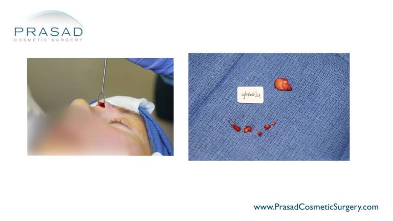 Semi-Permanent and Permanent Fillers: What You Need to Know