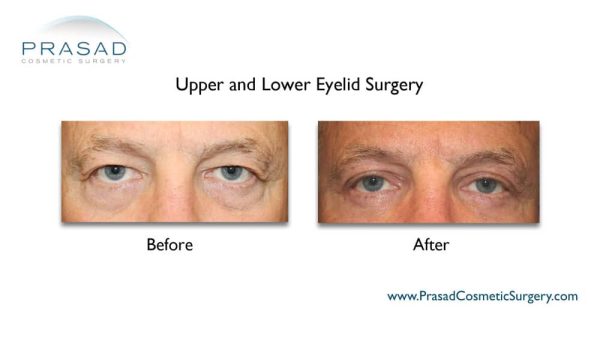 Hooded Eyelid Surgery: Results and Recovery