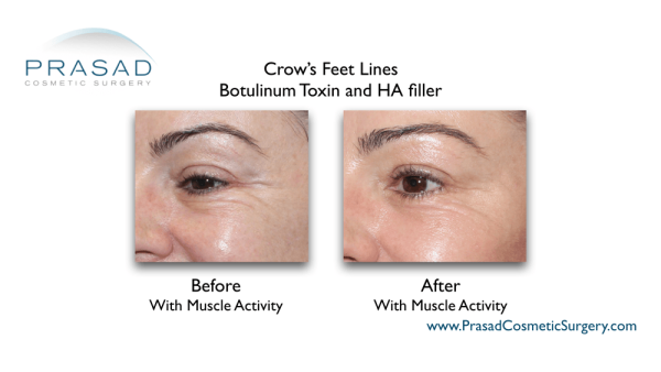 How Long Does Botox Last? Results, and Limitations Explained