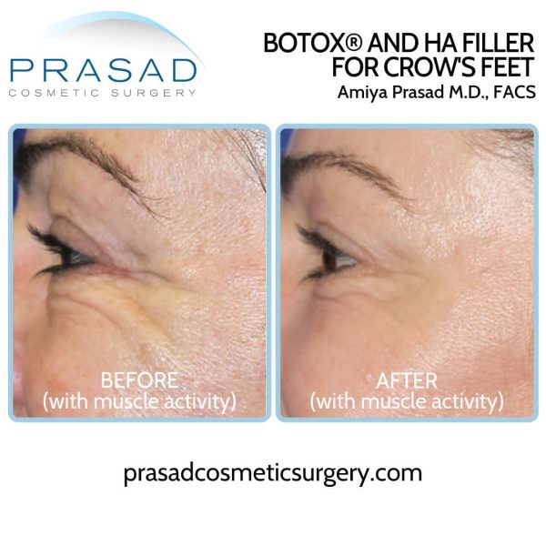How Long Does Botox Last? Results, and Limitations Explained