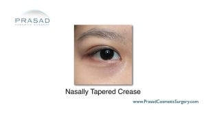 Parallel or Tapered Eyelid Crease for Asian Eye Surgery